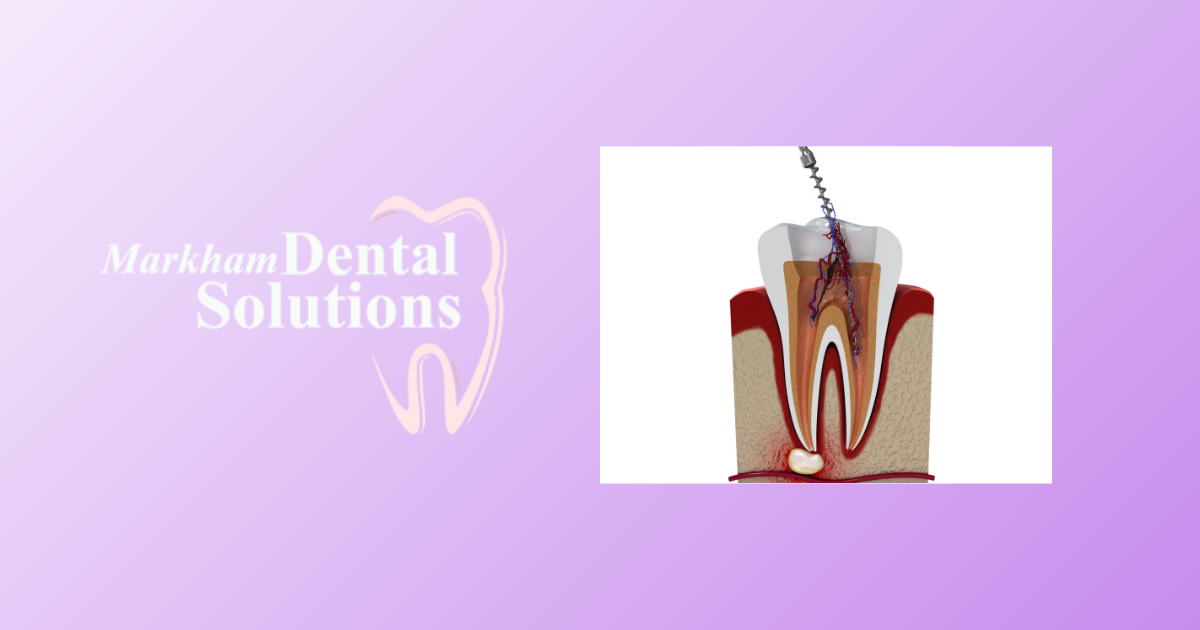 Root Canal Treatment | Markham Dental Solutions - Dr. Anet Biuss